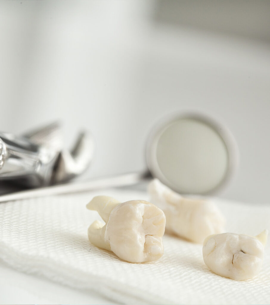 Tooth Extraction Anaheim | Wisdom Teeth Removal Orange County