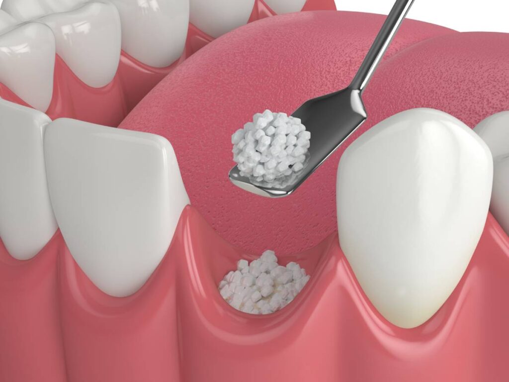 Do You Need a Bone Graft After Tooth Extraction? | Tarun Patel, DDS